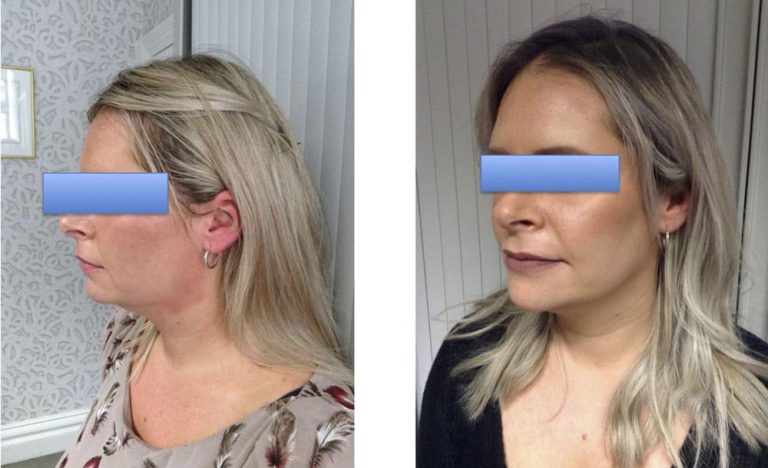 Genioplasty surgical procedure Explained | Wentworth Clinic